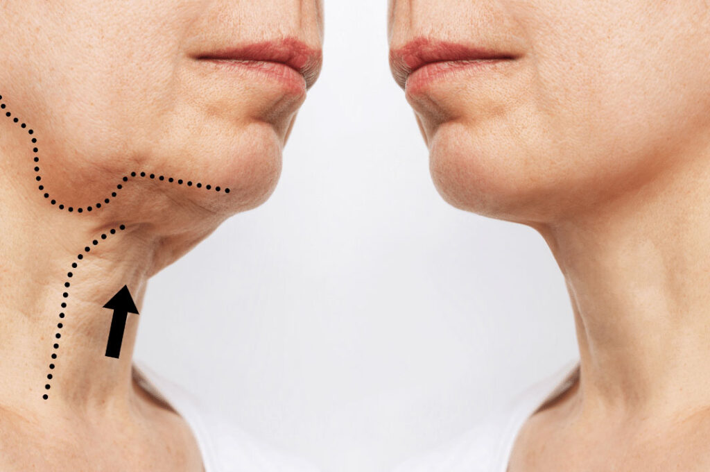 Platismoplastia - MFG Odontologia