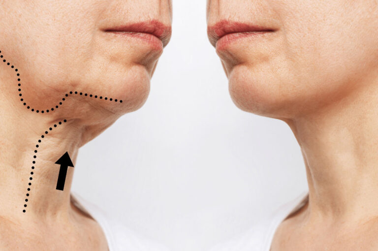 Platismoplastia - MFG Odontologia